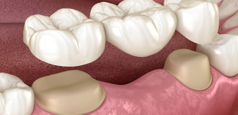 Fixed Bridges | Ana Pesaturo